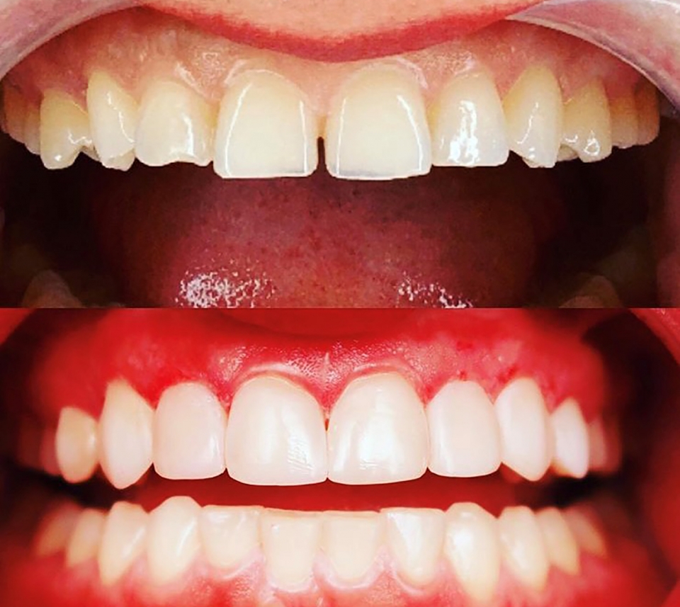 Before And After Dental Treatment Gallery | Trillium Smile Dentistry